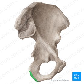 Avulsion Fracture Of The Ischial Tuberosity In A Young