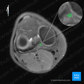 Posterior cruciate ligament: Anatomy and function | Kenhub