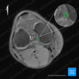Posterior cruciate ligament: Anatomy and function | Kenhub