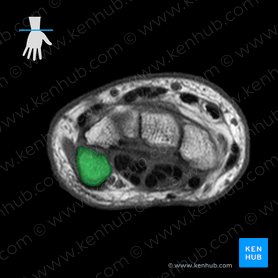 Pisiform bone: Anatomical structure and function | Kenhub