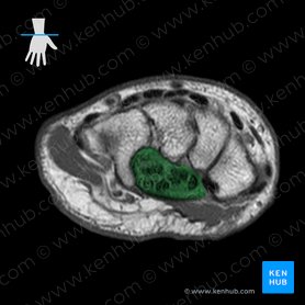 Handwurzelknochen: Anatomie, Gelenke, Kahnhbeinfraktur | Kenhub
