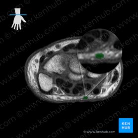 Palmaris longus: Origin, insertion and function | Kenhub