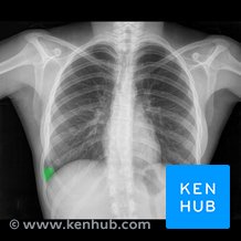 Costophrenic angle: Location and definition | Kenhub