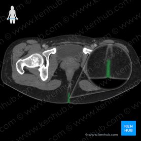 Intergluteal cleft: surface anatomy, location, features | Kenhub
