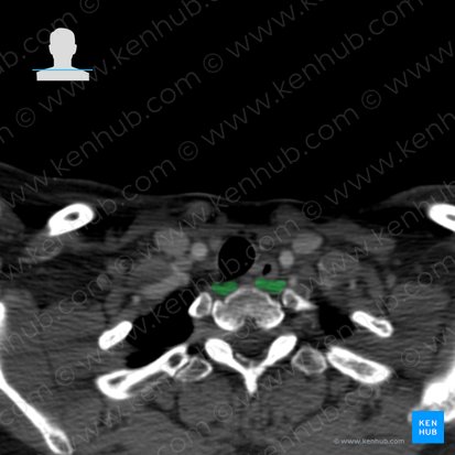 Prevertebral muscles, longus capitis muscle, anatomy | Kenhub