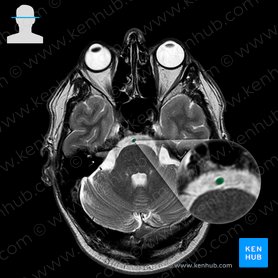 Basilar artery: Anatomy, course and branches | Kenhub