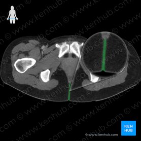 Intergluteal cleft: surface anatomy, location, features | Kenhub