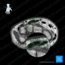 Extensor indicis: Origin, insertion and function | Kenhub
