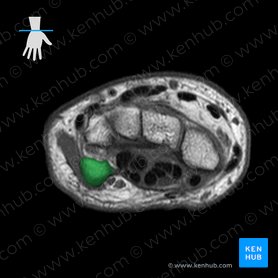 Pisiform bone: Anatomical structure and function | Kenhub