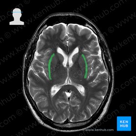 Brain MRI: How to read MRI brain scan | Kenhub