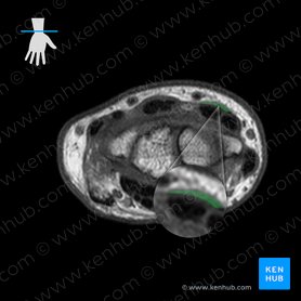 Wrist MRI: Interpretation, landmarks, anatomy | Kenhub