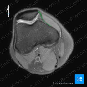 Cómo leer una RM de rodilla normal | Kenhub