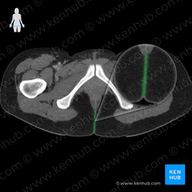 Intergluteal cleft: surface anatomy, location, features | Kenhub