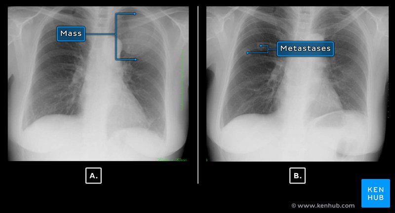 Giant first rib tumor: Clinical case, imaging and surgery | Kenhub