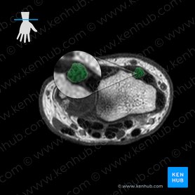 Wrist MRI: Interpretation, landmarks, anatomy | Kenhub
