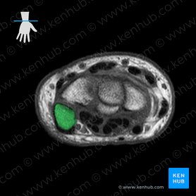 Pisiform bone: Anatomical structure and function | Kenhub