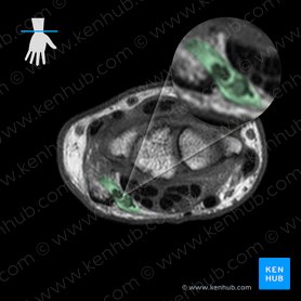 Wrist MRI: Interpretation, landmarks, anatomy | Kenhub