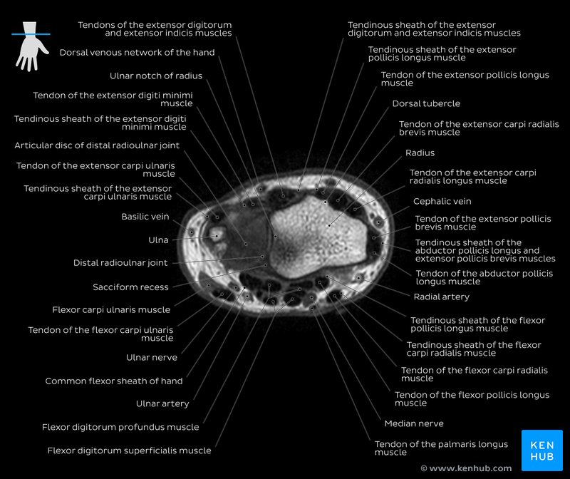 Wrist MRI: Interpretation, landmarks, anatomy | Kenhub