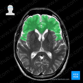 Brain MRI: How to read MRI brain scan | Kenhub