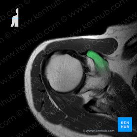 Normal shoulder MRI: How to read a shoulder MRI | Kenhub