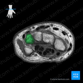 Wrist MRI: Interpretation, landmarks, anatomy | Kenhub