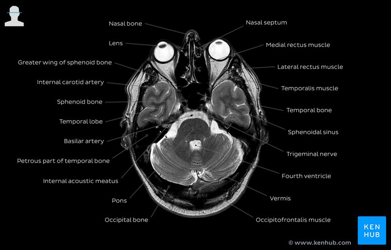 MRI: Types, indications, contraindications, advantages | Kenhub
