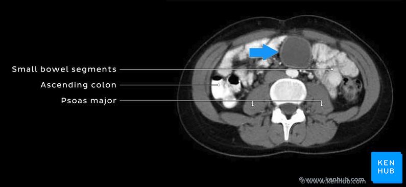 Urachal cyst: Clinical anatomy | Kenhub