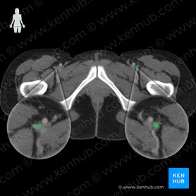 Deep femoral artery: Anatomy, branches, supply | Kenhub