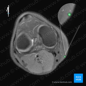 Great saphenous vein: Anatomy and clinical conditions | Kenhub