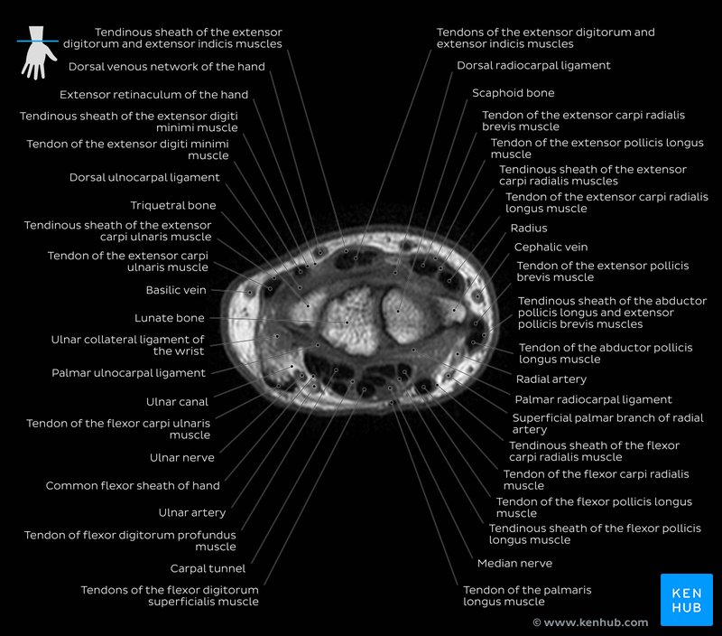 Wrist MRI: Interpretation, landmarks, anatomy | Kenhub