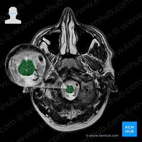 Brain MRI: How to read MRI brain scan | Kenhub