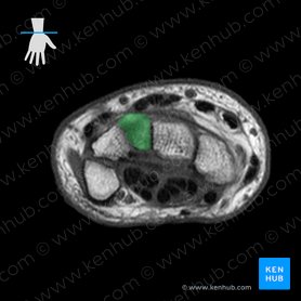 Túnel do carpo: Anatomia, conteúdo e relevância clínica | Kenhub