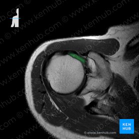 Normal shoulder MRI: How to read a shoulder MRI | Kenhub