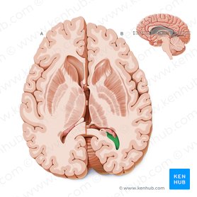 Lateral ventricles: Anatomy and function | Kenhub