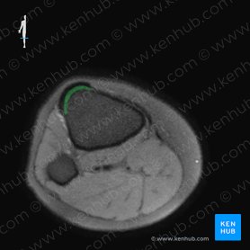 Tibial tuberosity: location, anatomy and function | Kenhub