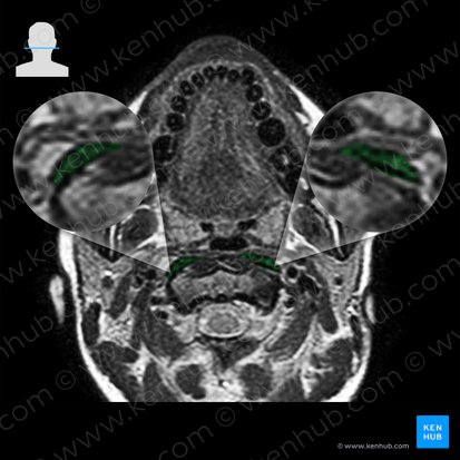 Prevertebral muscles, longus capitis muscle, anatomy | Kenhub