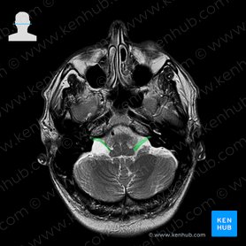 Vestibulocochlear nerve (CN VIII): Anatomy and pathway | Kenhub