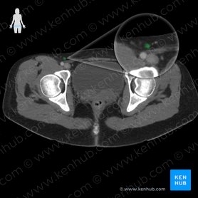 Inguinal lymph nodes: Anatomy and function | Kenhub