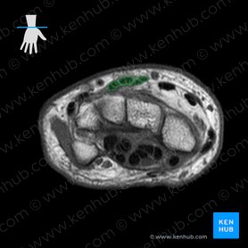 Extensor indicis: Origin, insertion and function | Kenhub