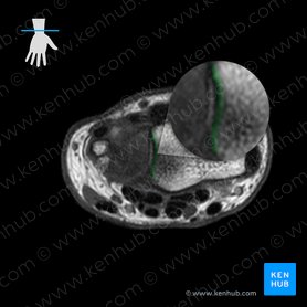 Distal radioulnar joint: Anatomy, movements | Kenhub