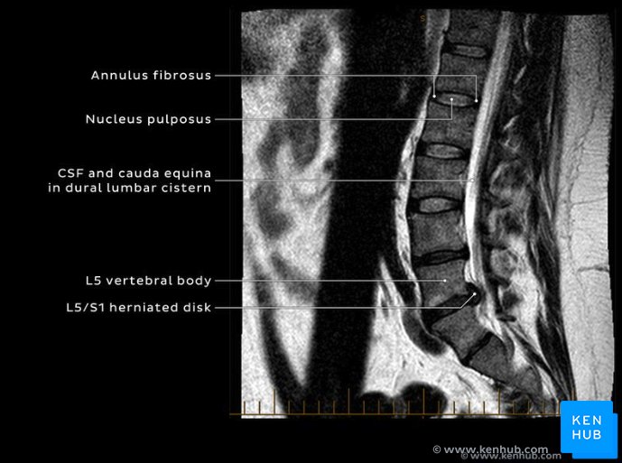 Radiculopathy and surgery: Anatomical considerations | Kenhub