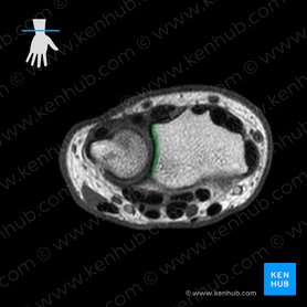 Radio y ulna (cúbito): Anatomía y funciones | Kenhub