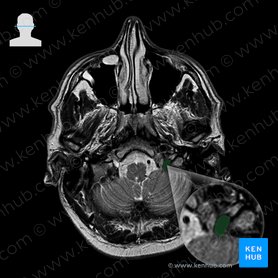 Sigmoid sinus: Anatomy | Kenhub