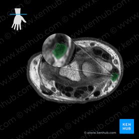 Abductor pollicis longus: Origin, insertion and function | Kenhub
