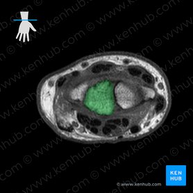 Wrist MRI: Interpretation, landmarks, anatomy | Kenhub