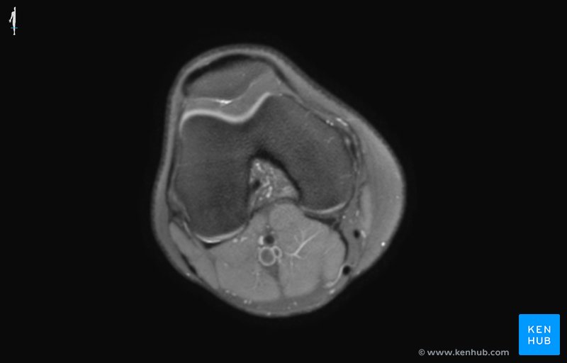 How to read the normal knee MRI | Kenhub