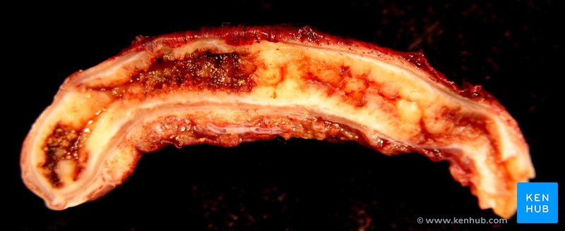 Cecum and vermiform appendix: Anatomy and function | Kenhub