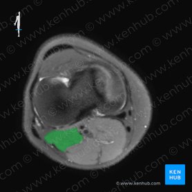 Plantaris: Origins, insertions, innervation and actions | Kenhub
