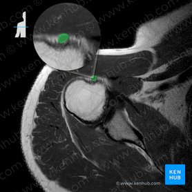Normal shoulder MRI: How to read a shoulder MRI | Kenhub